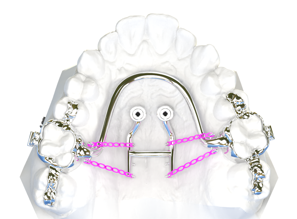 Molar Intrusion Device Dual Implants - Ortho Tech Lab