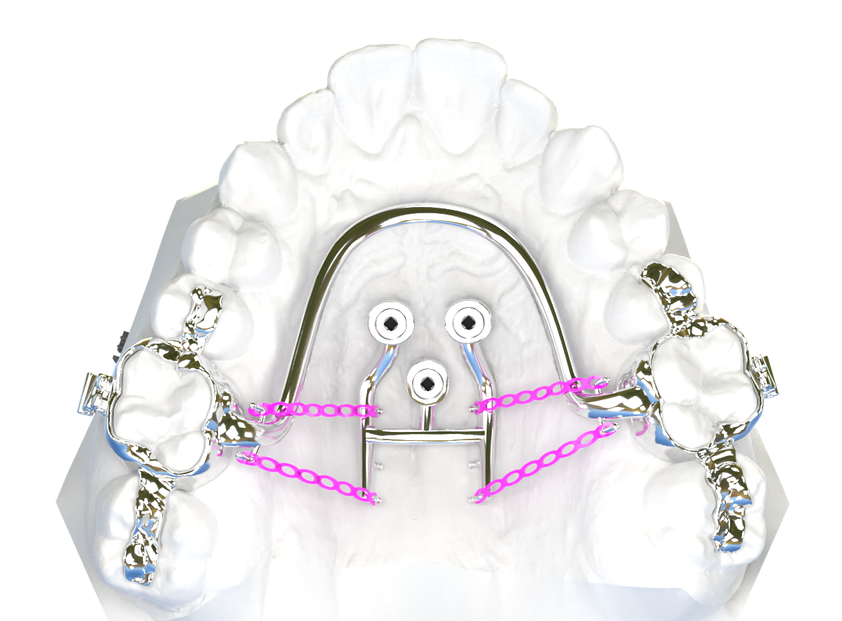 Molar Intrusion Device Triple Implants - Ortho Tech Lab