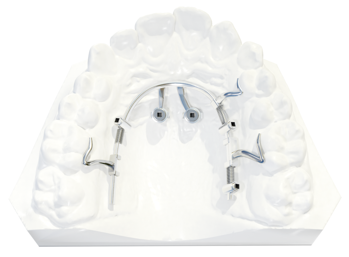 Mesialdistalslider with Bonded Molar and Premolar Tubes - Ortho Tech Lab