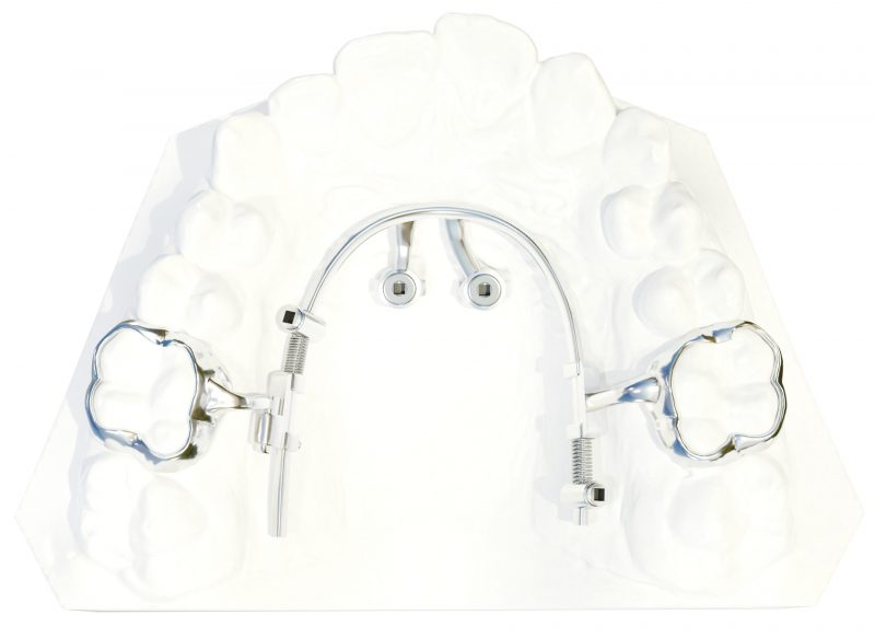 Mesialdistalslider with Molar Shells - Ortho Tech Lab