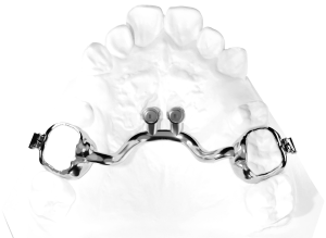 Transpalatal Arch - Ortho Tech Lab
